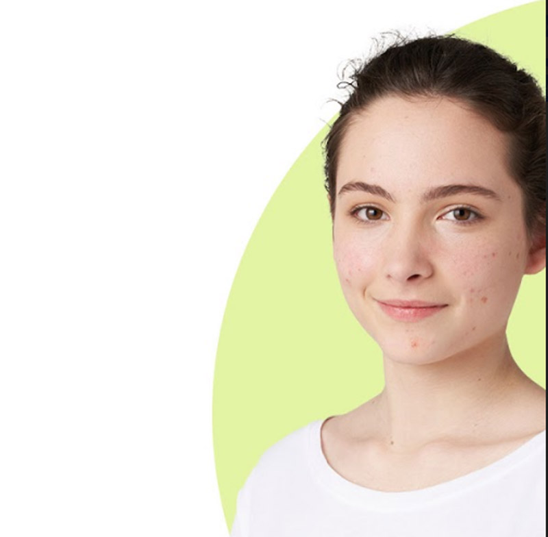 Algunas recomendaciones para combatir el acné de forma holística ...